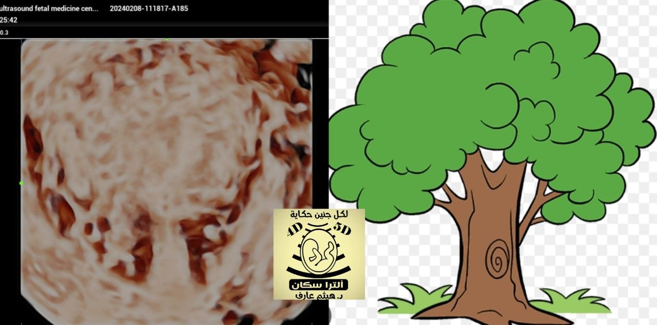 Tree sign in adenomyosis by 5D ultrasound - ultrascan center - الترا سكان