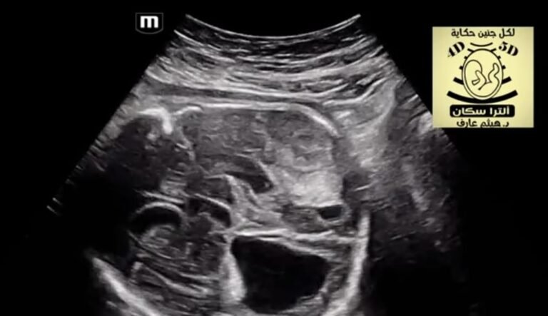 Fetal intracranial hemorrhage ultrasound - ultrascan center - الترا سكان