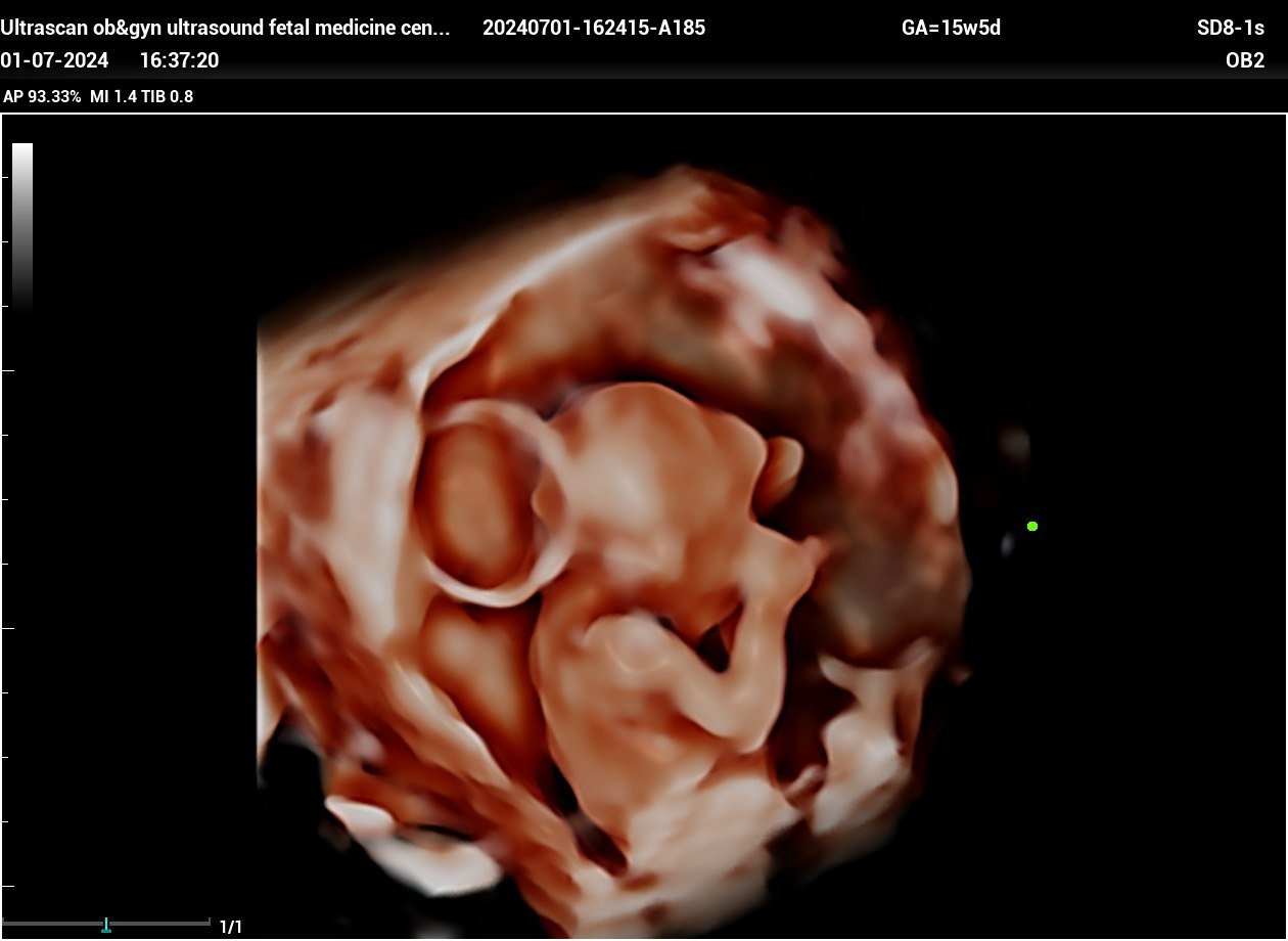 occipital encephalocele fetal ultrasound by Dr.Sara Salem, Lybia ...