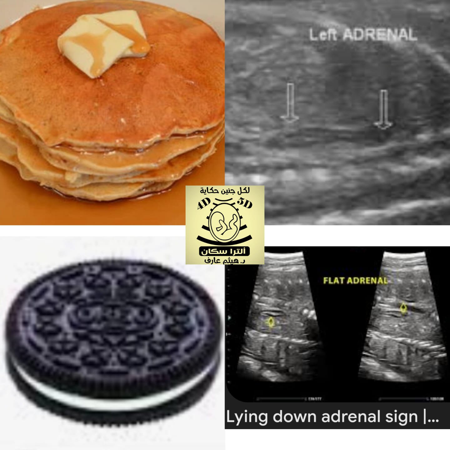 pancake sign , oreo sign , lying down adrenal sign in fetal ultrasound ...