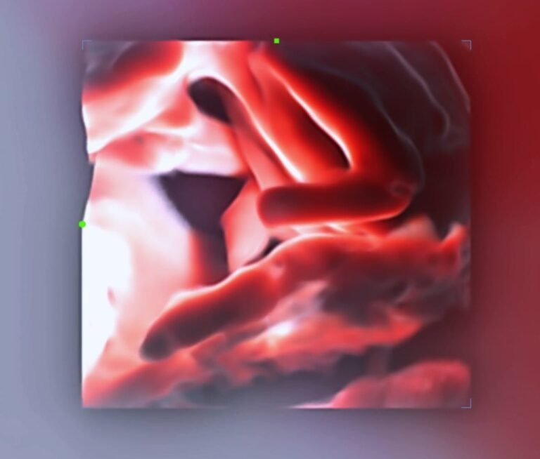 Terminal transverse limb defects affecting 4 limbs with "nubbins" , a ...