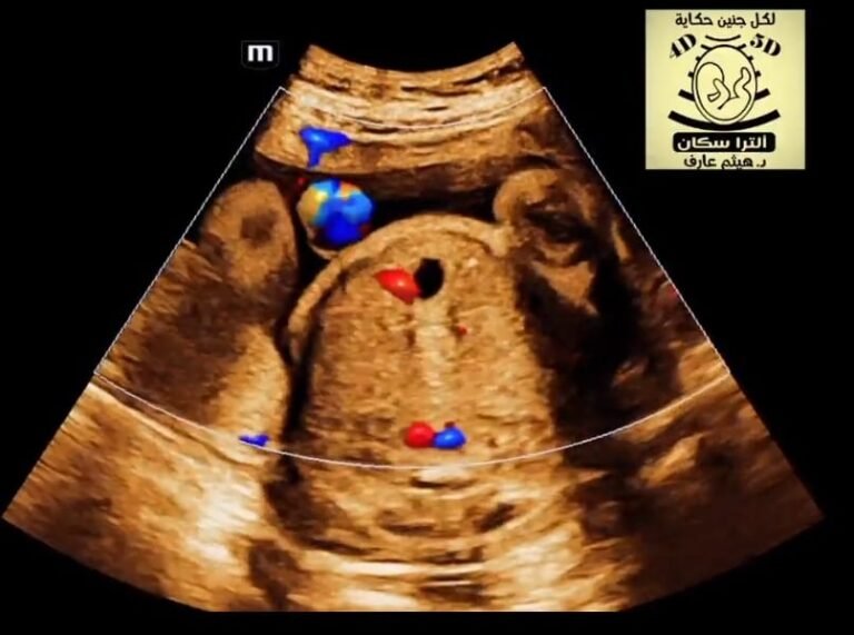 Persistent right umbilical vein - ultrascan center - الترا سكان
