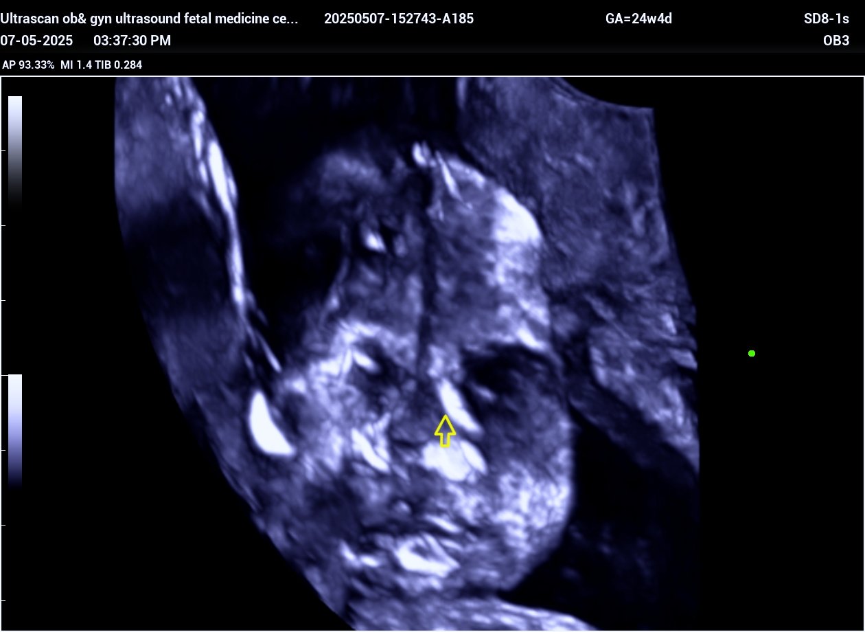 Unilateral Absence of the Nasal Bone (NB) fetal ultrasound - ultrascan ...
