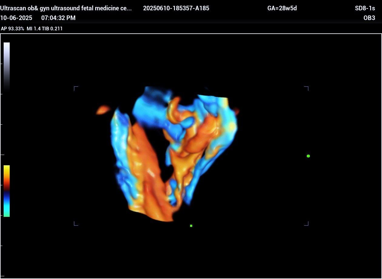 true knot in the umbilical cord fetal ultrasound - ultrascan center ...