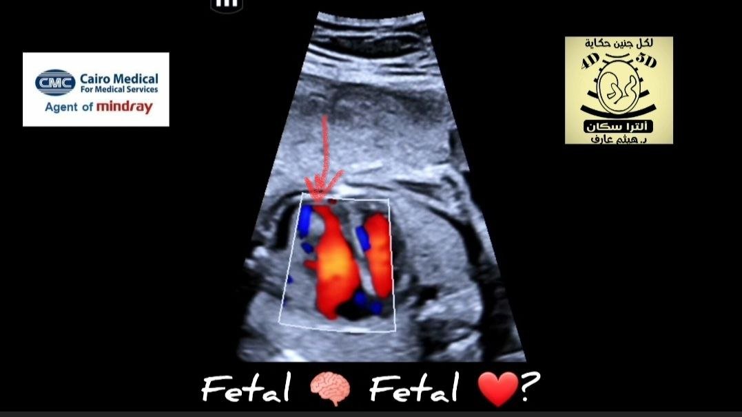 Fetal right ventricular noncompaction cardiomyopathy (RVNCC ...