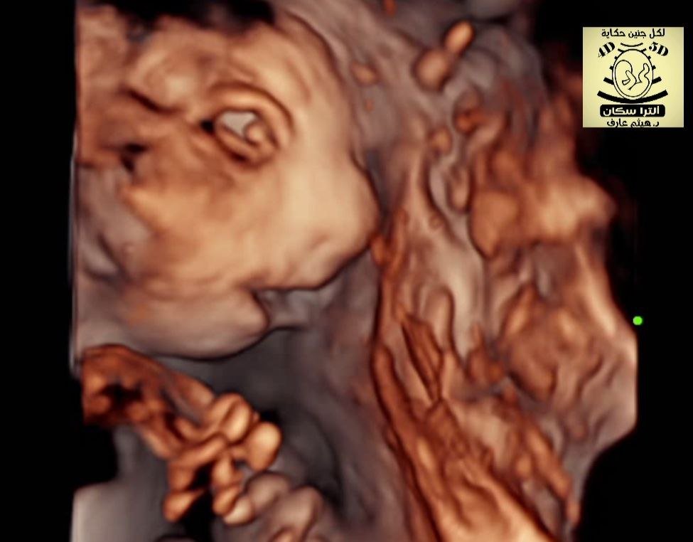 Neu–Laxova syndrome - ultrascan center - الترا سكان