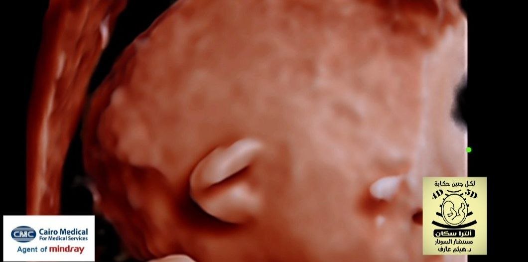 Low set ear 👂 with microtia in trisomy 21 fetal ultrasound - ultrascan ...